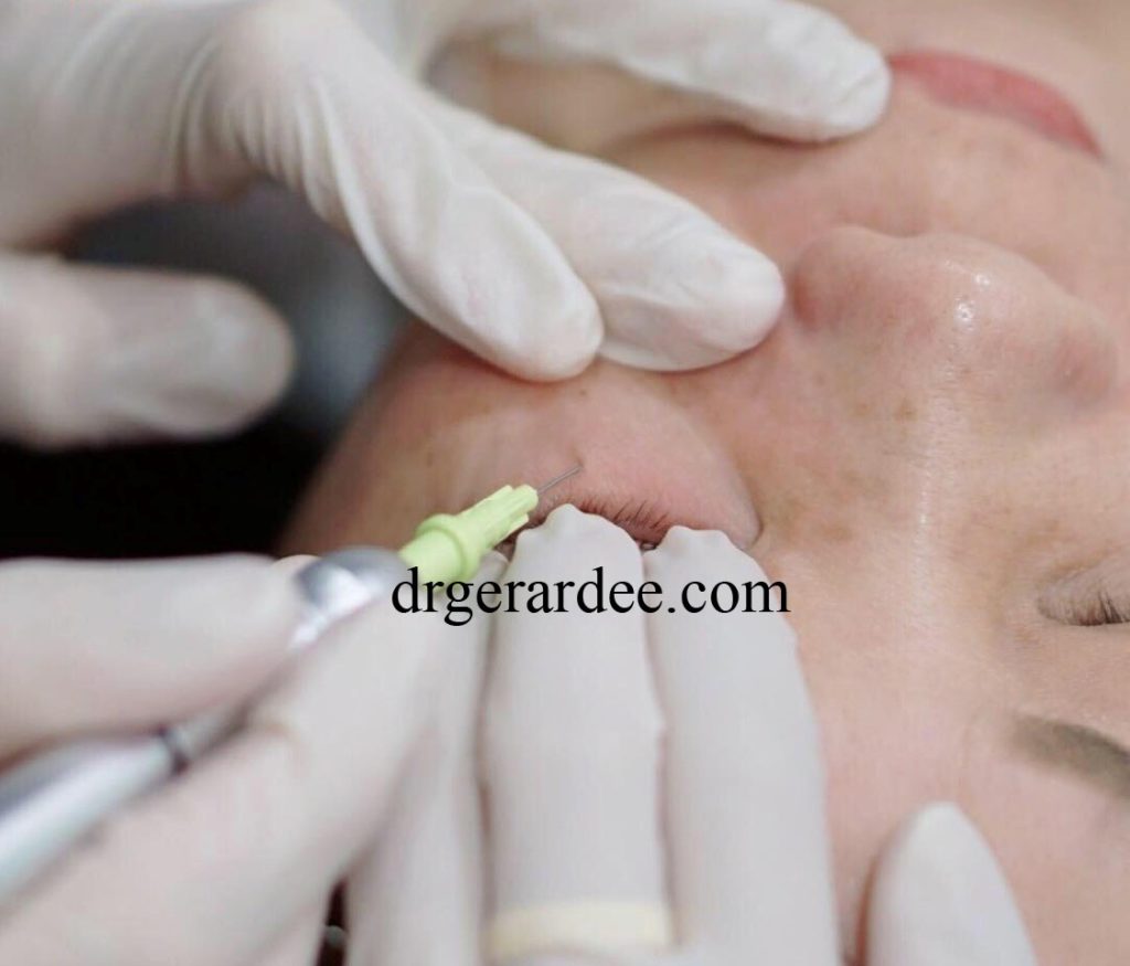 Agnes & Secret RF: Non-Surgical Eye Bag Removal | Dr Gerard Ee