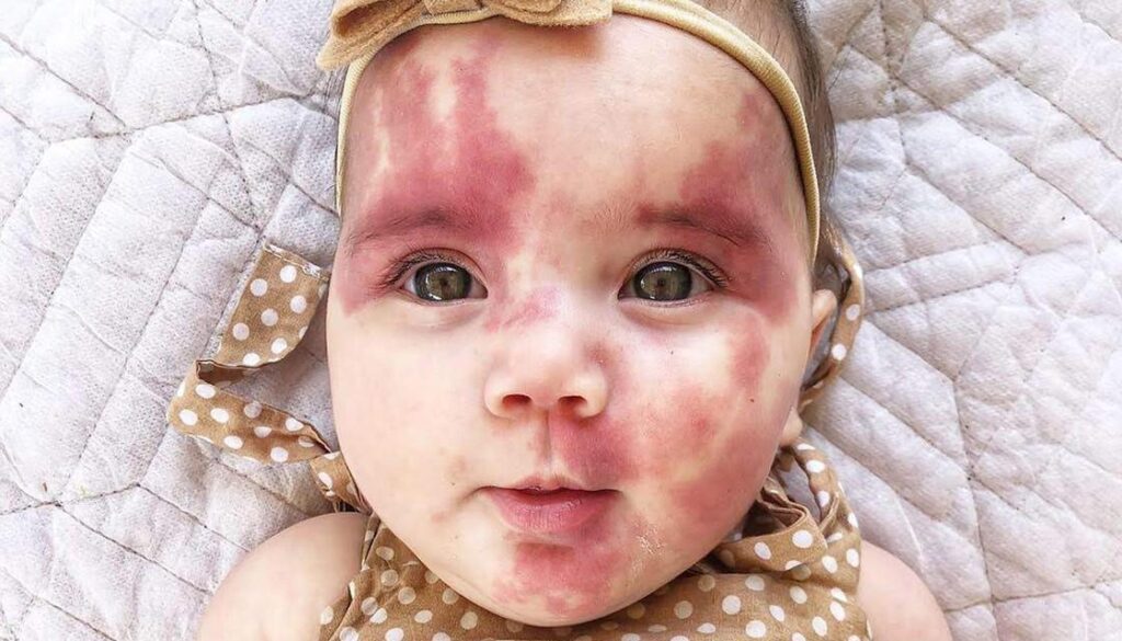 What is the difference between a Port Wine Stain and a haemangioma ...