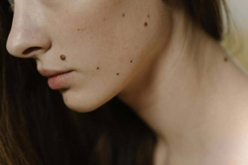A Guide to Excision Biopsy for Moles