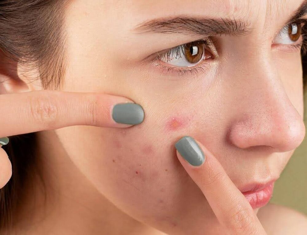 New Acne Treatment: Gold Photothermal Therapy (Gold PTT) | Dr Gerard Ee